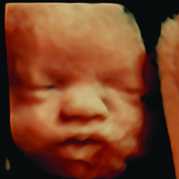 Photo Gallery - 4D Love At First Sight - 4D/HD Elective Ultrasound in ...